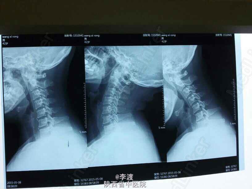 椎体去旋转技术
