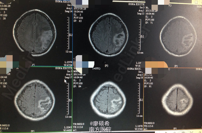 初见之特殊影像学表现的急性脑梗死1例。 医联