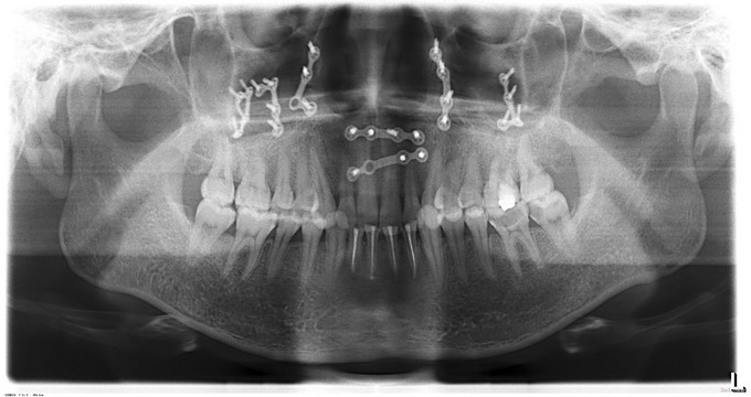 上颌骨骨折术后-医联