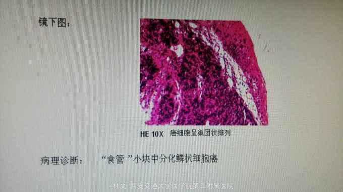 食管鳞癌红蓝铅笔绘图 食管鳞状细胞手绘图 食管鳞状细胞 大山谷图库