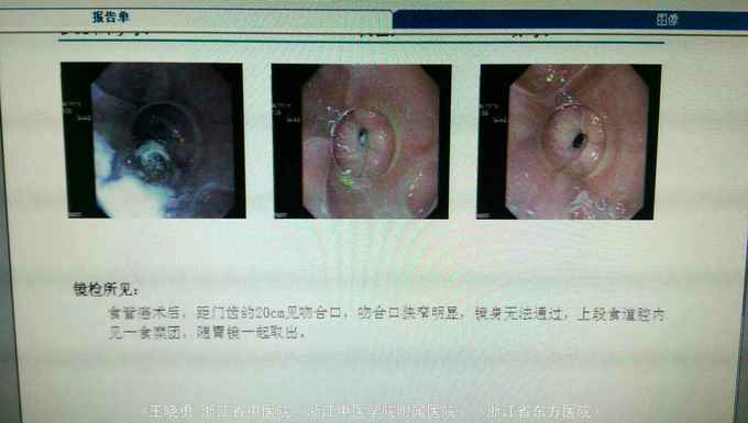 食管癌三切口术后吻合口狭窄 医联
