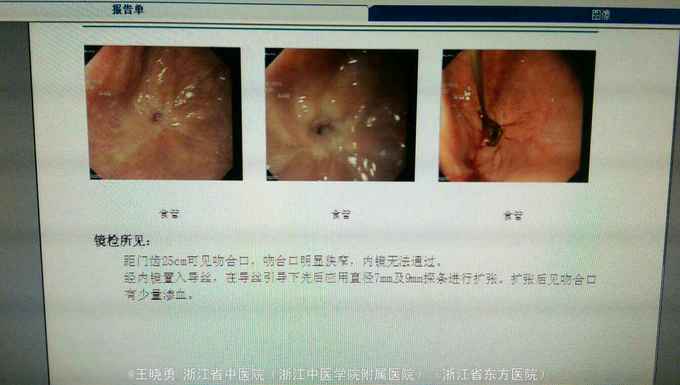 食管癌三切口术后吻合口狭窄 医联
